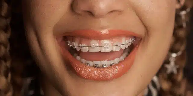 5 Tips for Loving Your Braces - Perfect Smiles Orthodontics