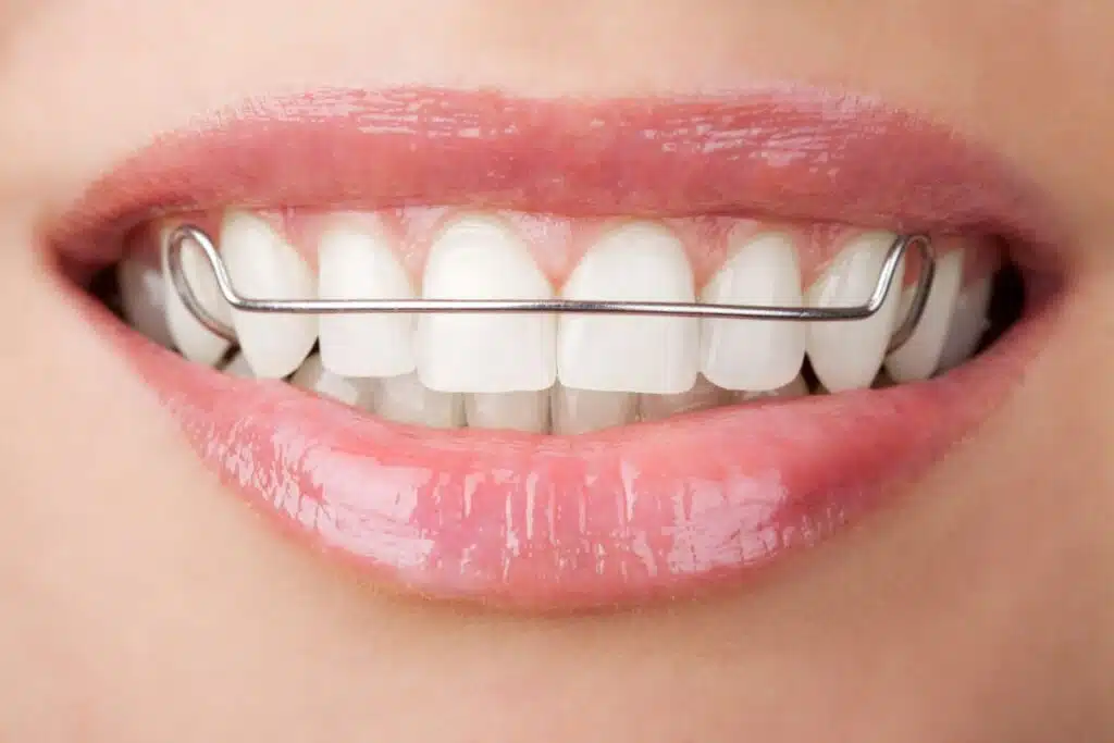 Retainers - Perfect Smiles Orthodontics